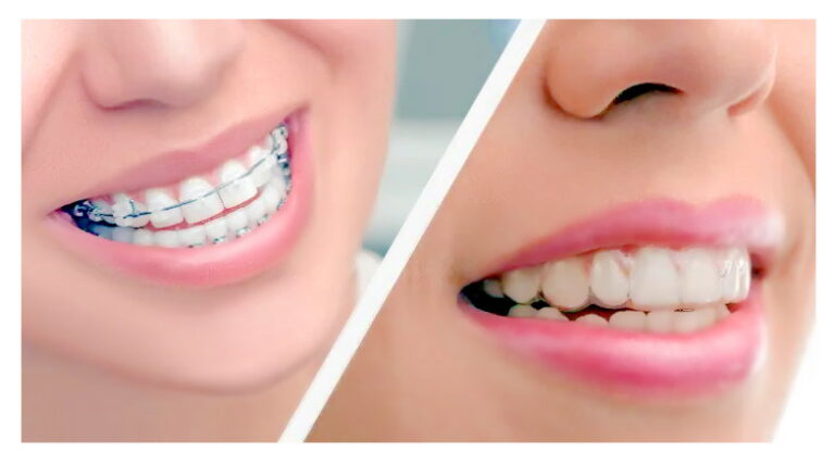 Invisalign vs. Braces: An Overview of Orthodontic Options - Orthosmile ...